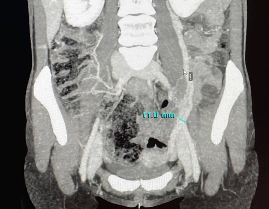 Varices pélvicas – Maday Cabrero